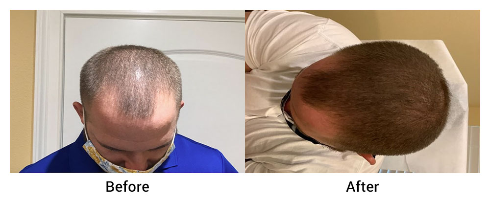 PRP Before and After Gallery - Indigo Dermatology