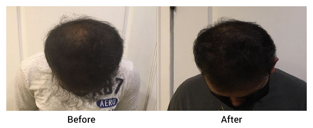 PRP Before and After Gallery - Indigo Dermatology