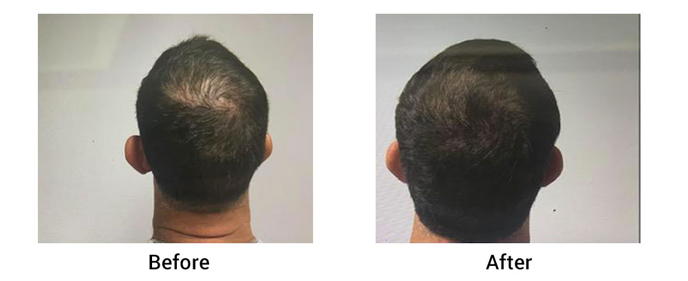 PRP Before and After Gallery - Indigo Dermatology