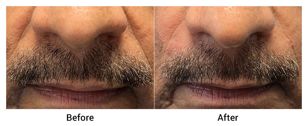 Nasolabial Folds Filler Before and After Gallery – Melbourne, FL ...