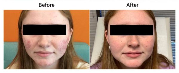 Acne Before and After Gallery - Indigo Dermatology