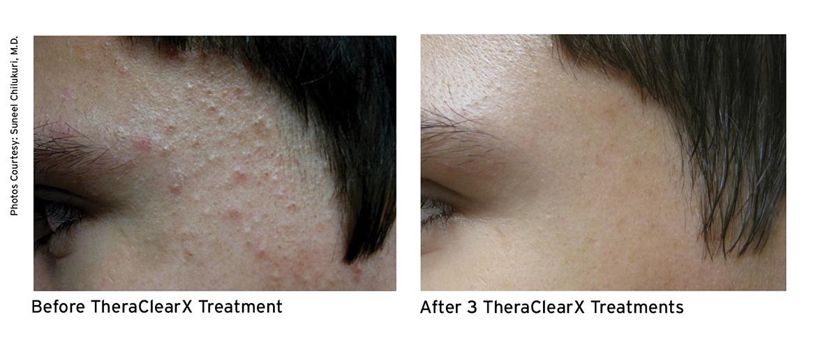 Acne Services in Melbourne, Tampa and Palm Bay, FL
