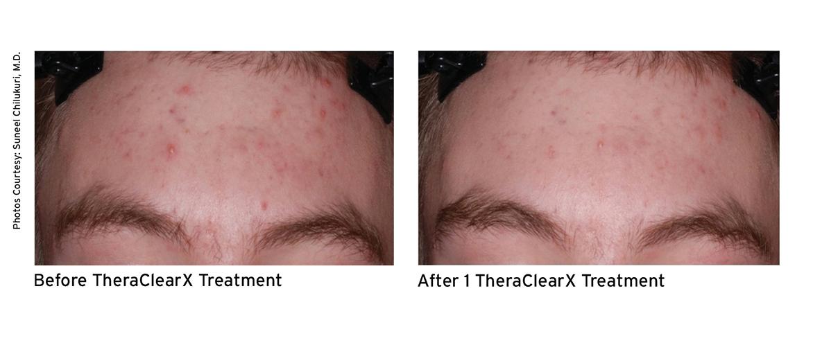 TheraClear®X Treatment in Melbourne, Tampa and Palm Bay, FL