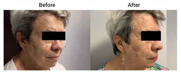 Facial Rejuvenation Before and After Gallery - Indigo Dermatology