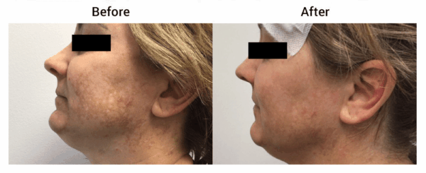 Melasma Before and After Gallery - Indigo Dermatology