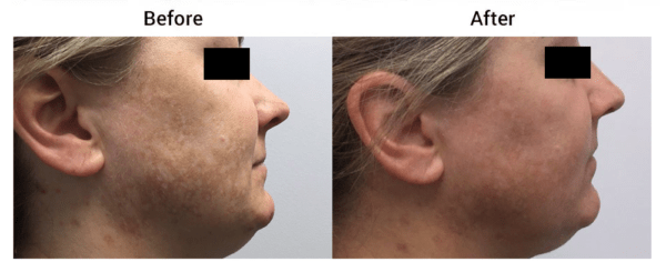 Melasma Before and After Gallery - Indigo Dermatology