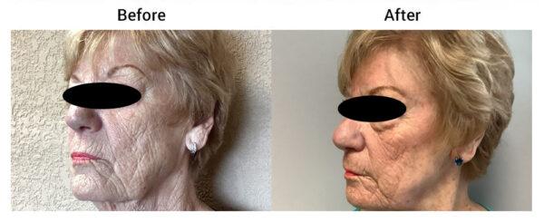 Medium Depth Chemical Peels Before and After Gallery - Indigo Dermatology